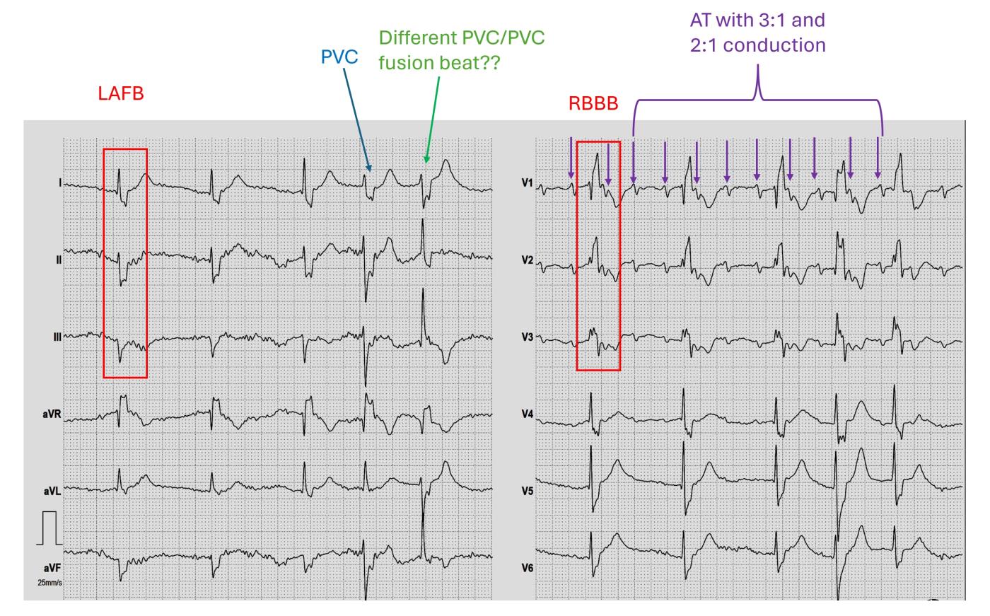 Complete Right Bundle Branch Block With AV Block and More | ECG Guru - Instructor Resources